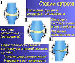 Остеоартроз. Лечение остеоартроза
